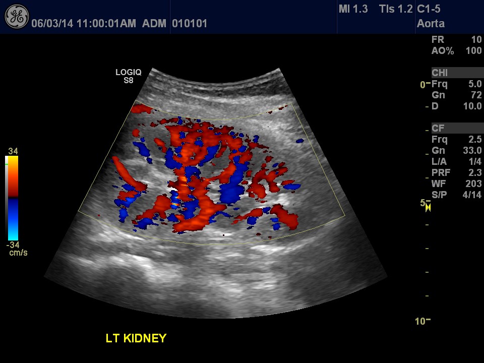 Blood Clot In Leg Ultrasound